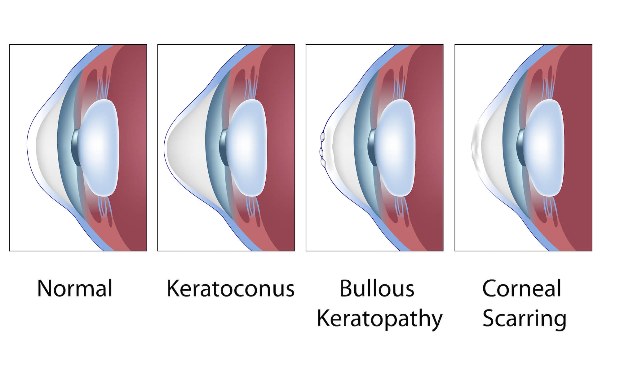 Cornea Tallahassee | Cornea Surgery FL | Eye Associates