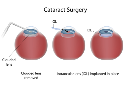Have Blurry, Distorted Vision? It May Be Due to Cataracts! | Eye ...